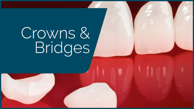 Crowns and Bridges, ConfidentalCR.com